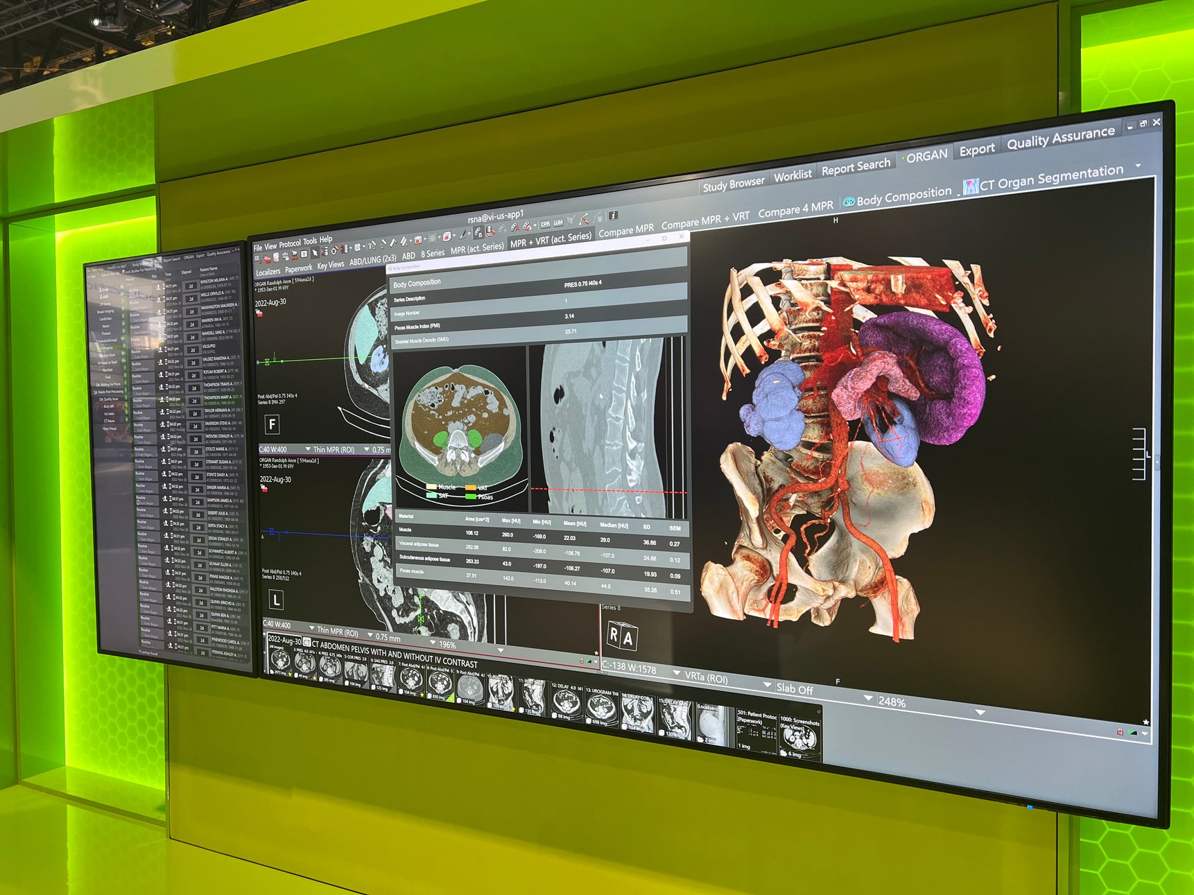 RSNA 2022 | Visage's Top Five